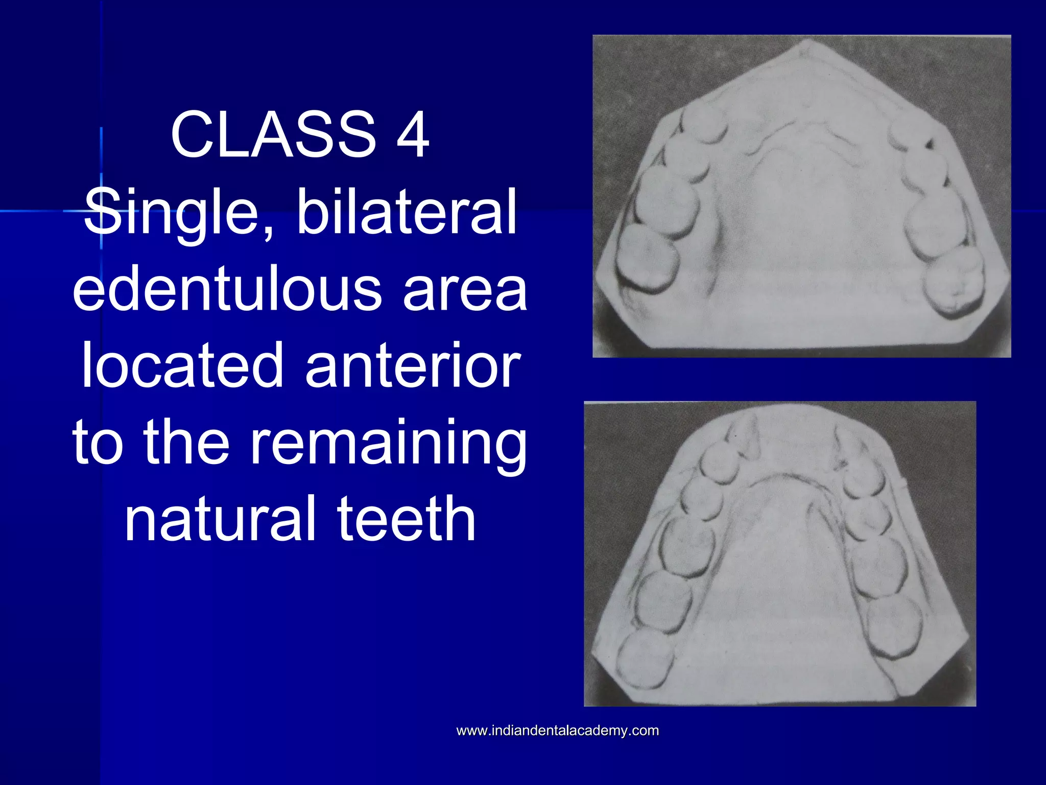 Components of removable partial denture prosthesis /certified fixed ...