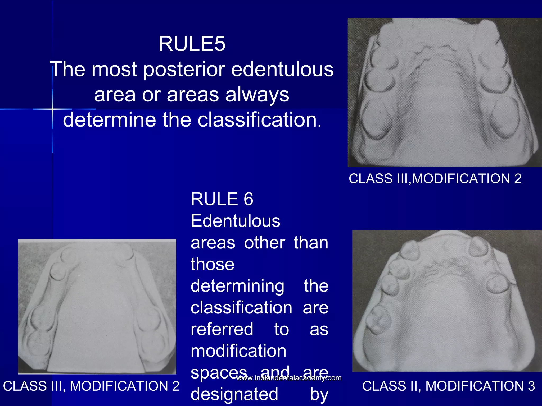 Components of removable partial denture prosthesis /certified fixed ...