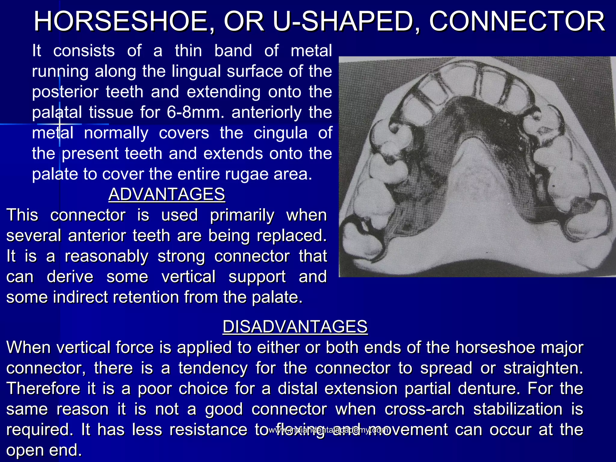 Components of removable partial denture prosthesis /certified fixed ...