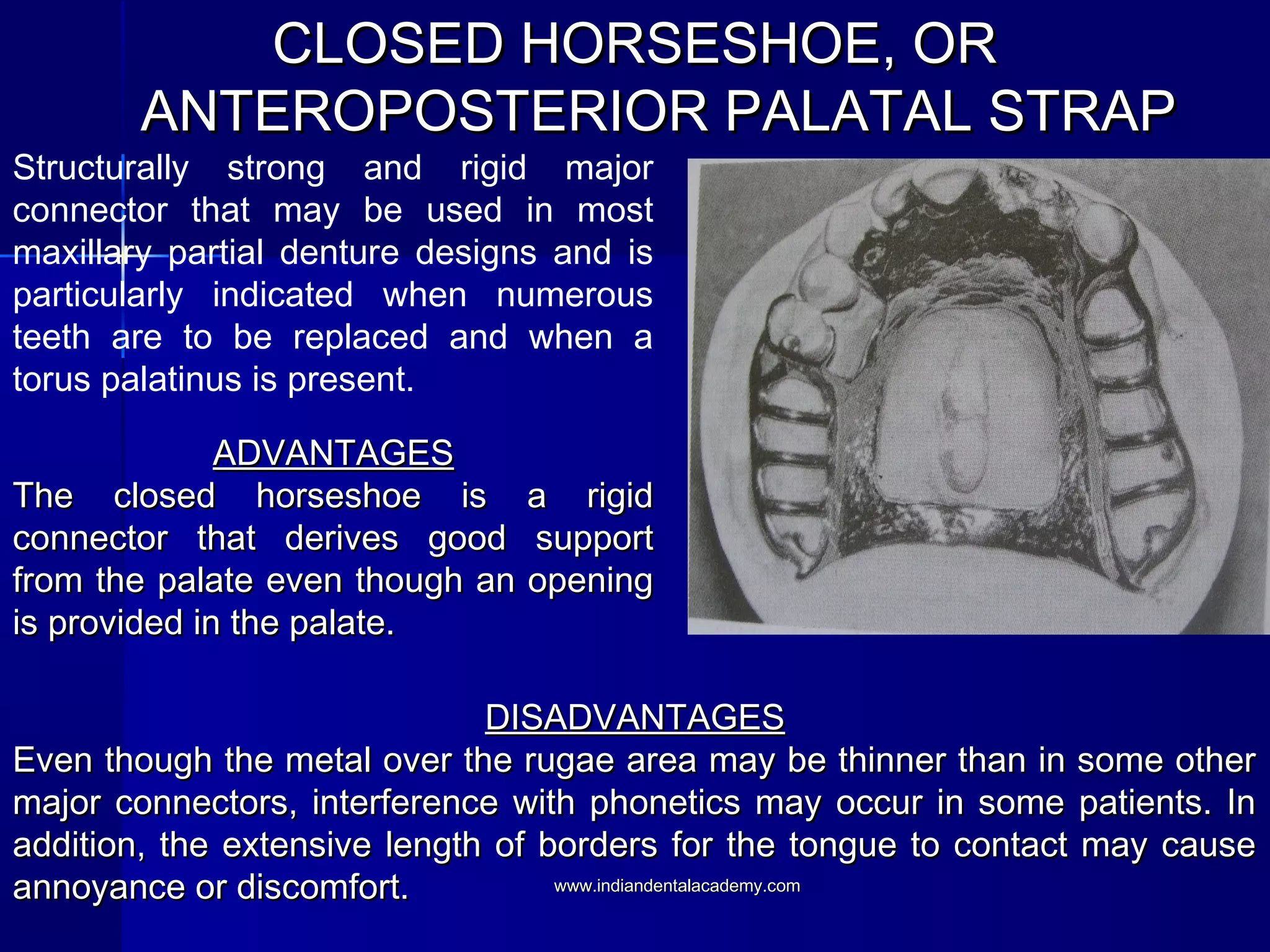 Components of removable partial denture prosthesis /certified fixed ...