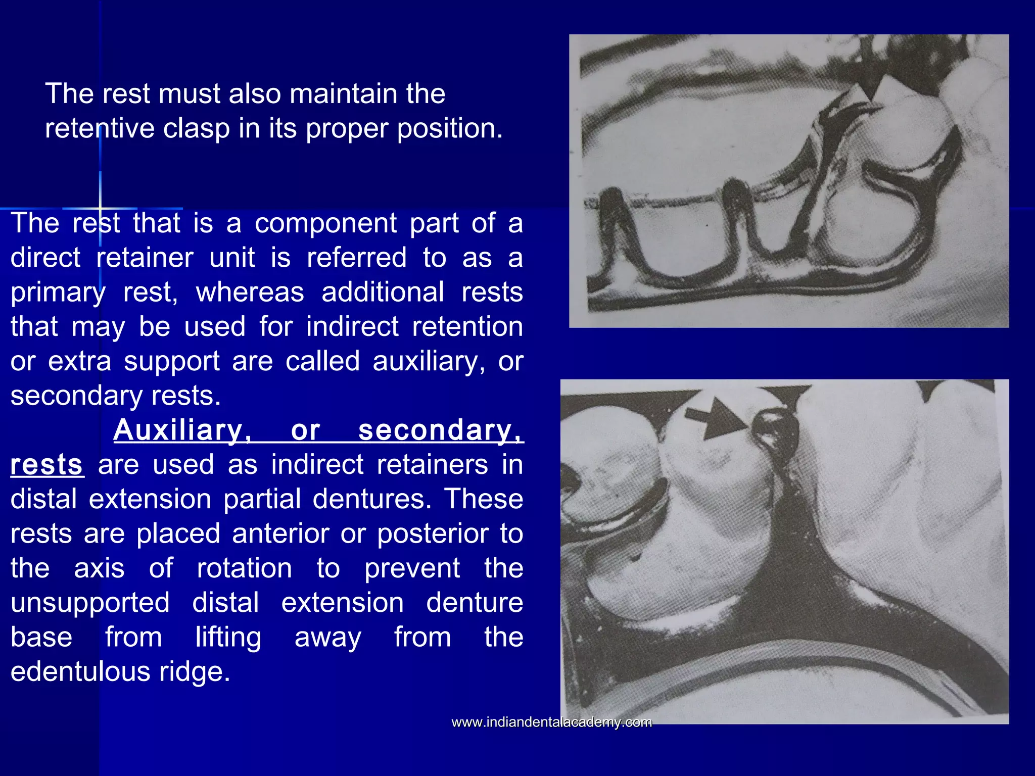 Components of removable partial denture prosthesis /certified fixed ...