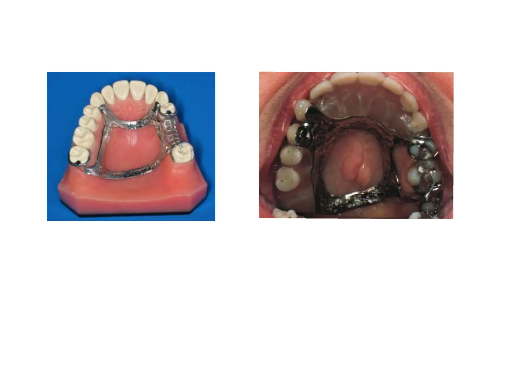 components of rpd.ppt