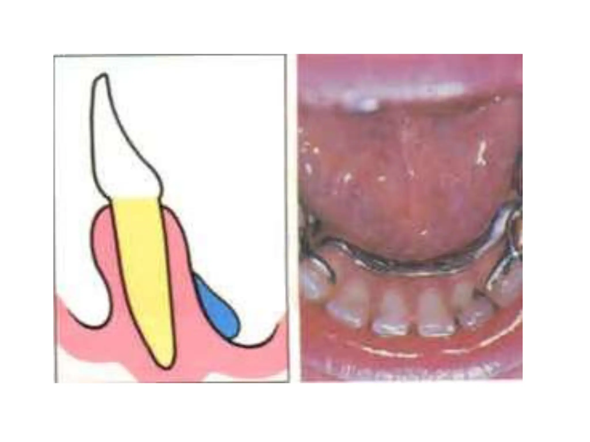 components of rpd.ppt