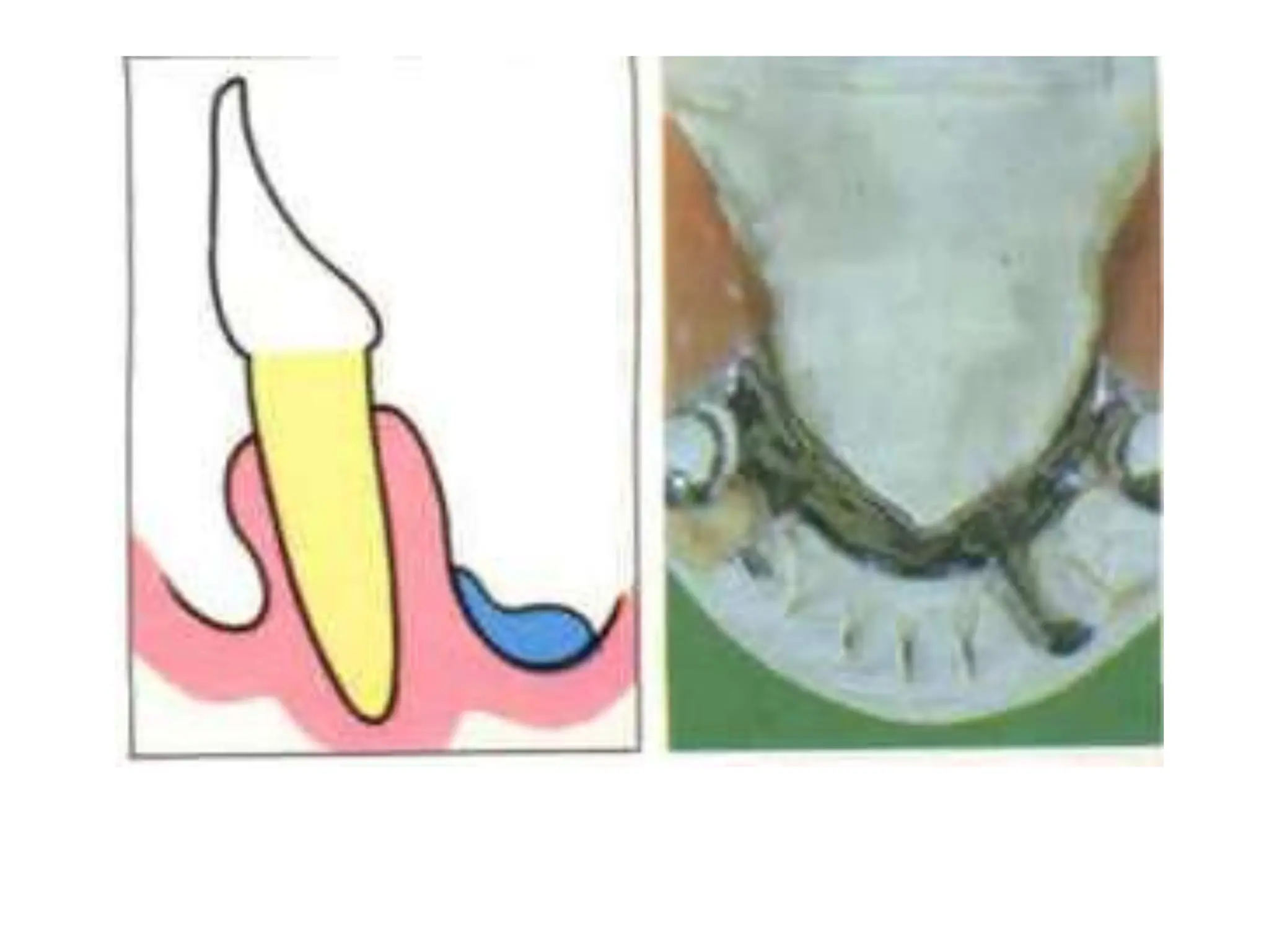 components of rpd.ppt