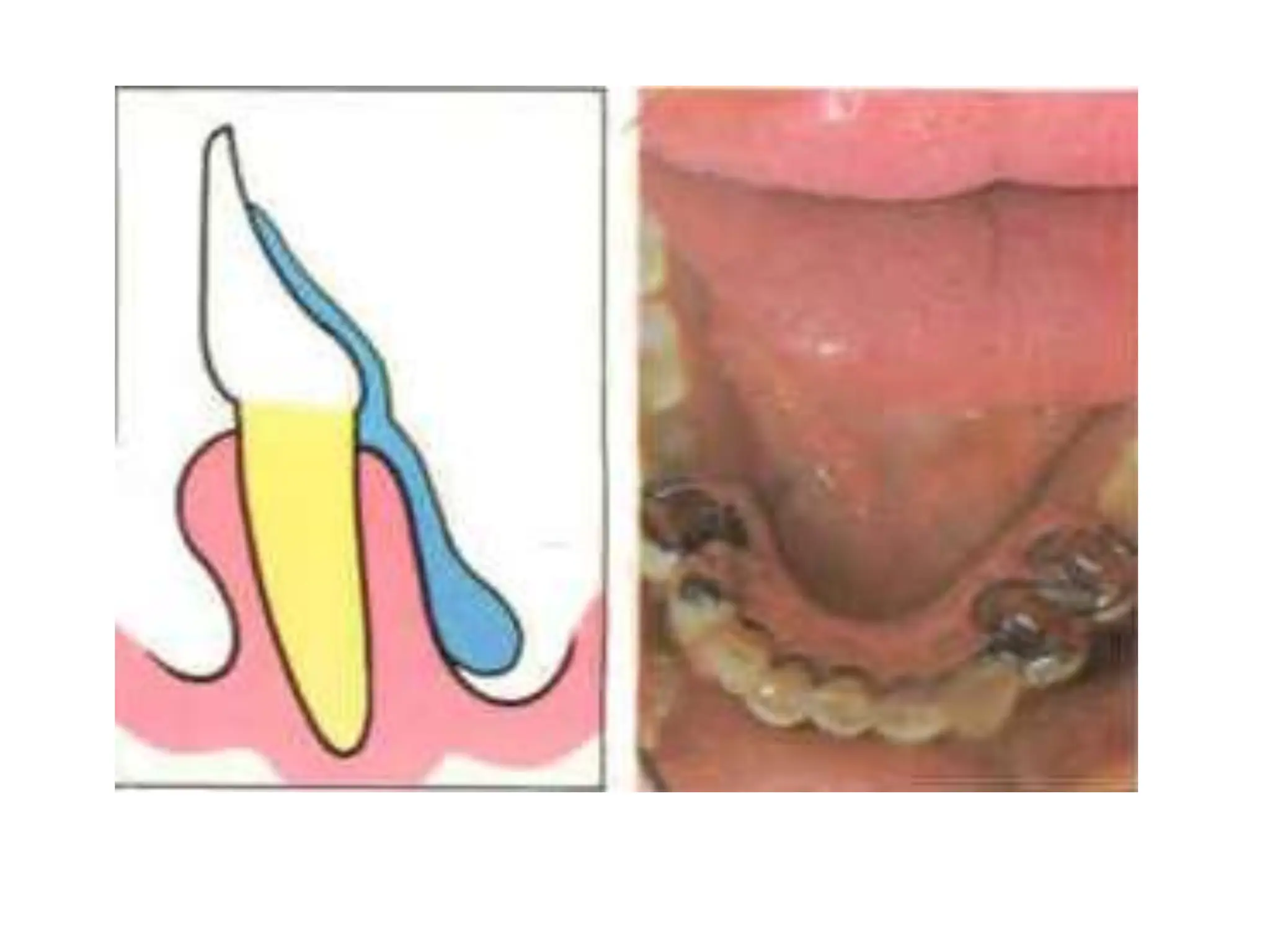 components of rpd.ppt