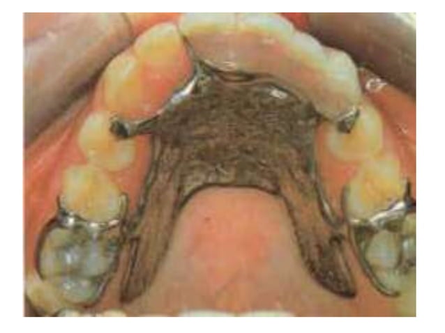 components of rpd.ppt
