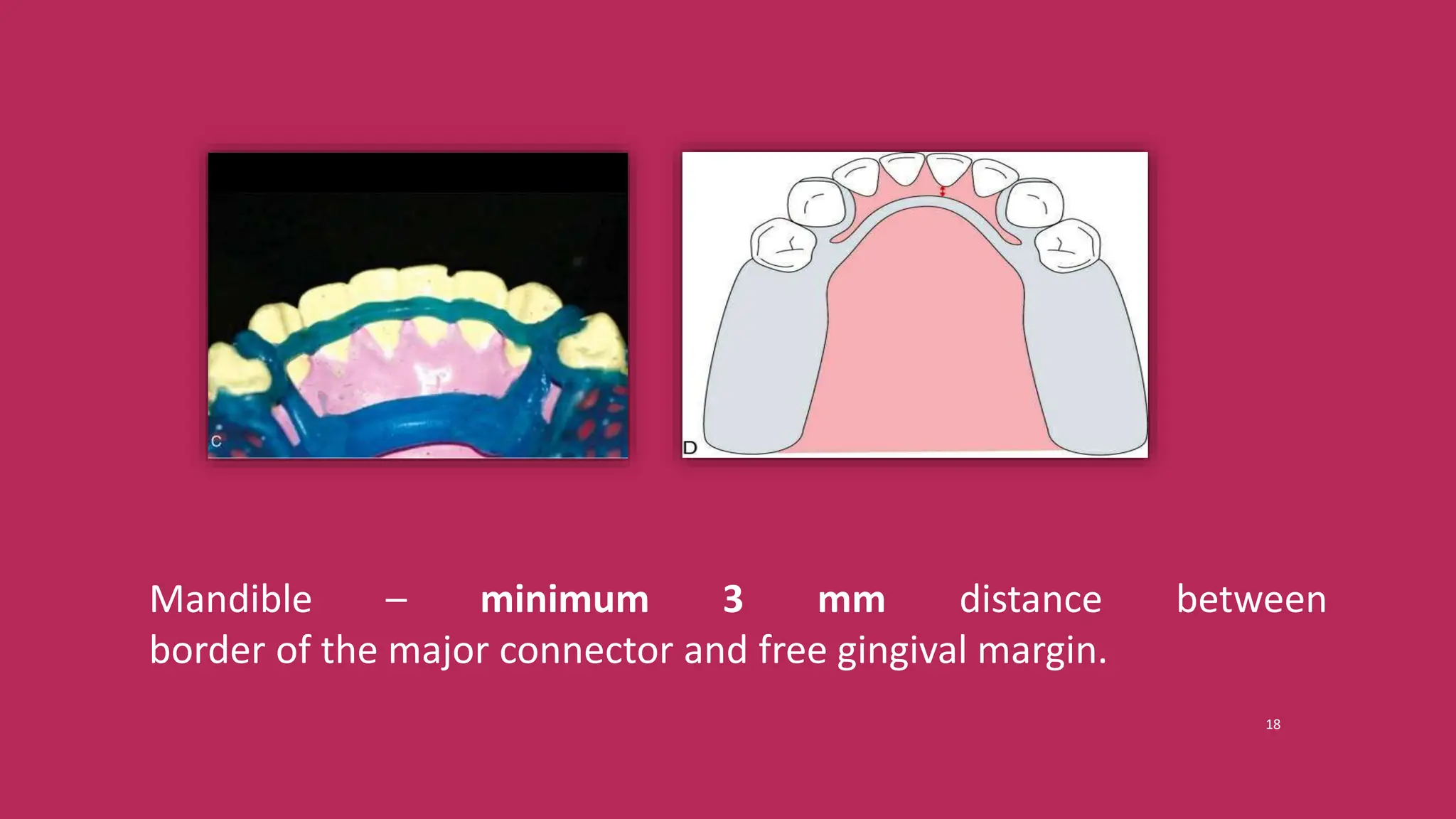 Components of RPD and Major connectors_Dr Shuchi Jain.pptx