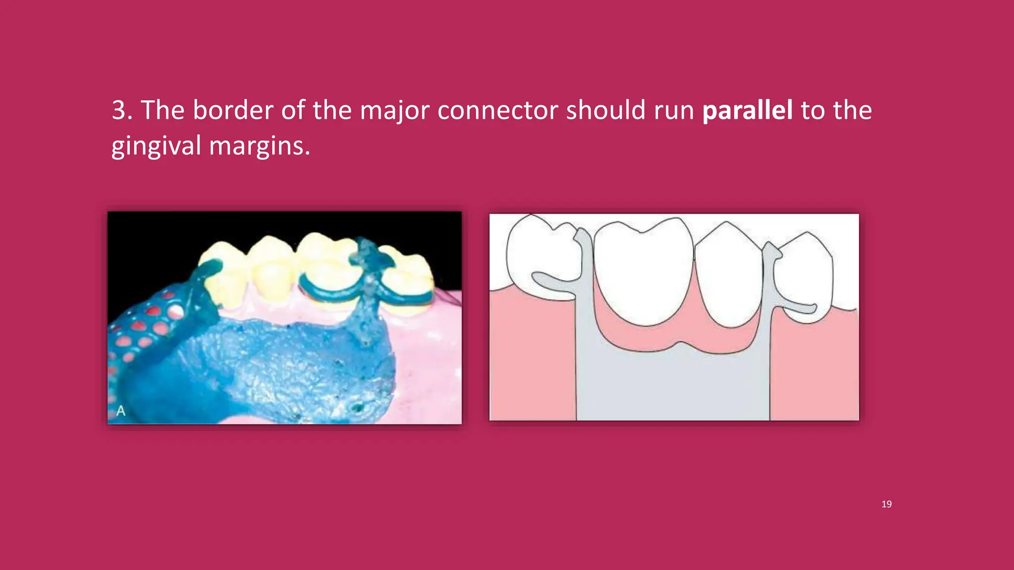 Components of RPD and Major connectors_Dr Shuchi Jain.pptx