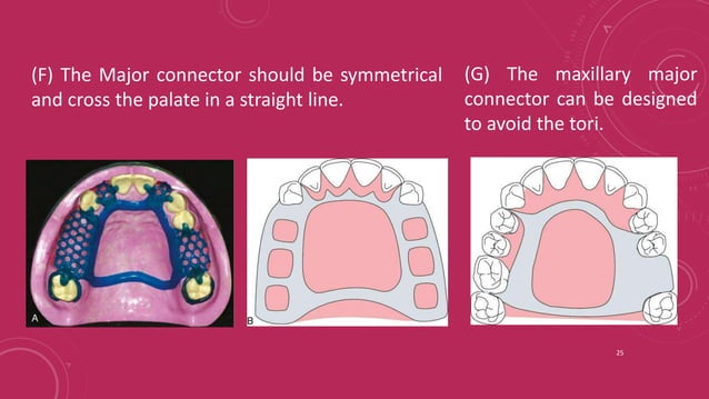 Components of RPD and Major connectors_Dr Shuchi Jain.pptx