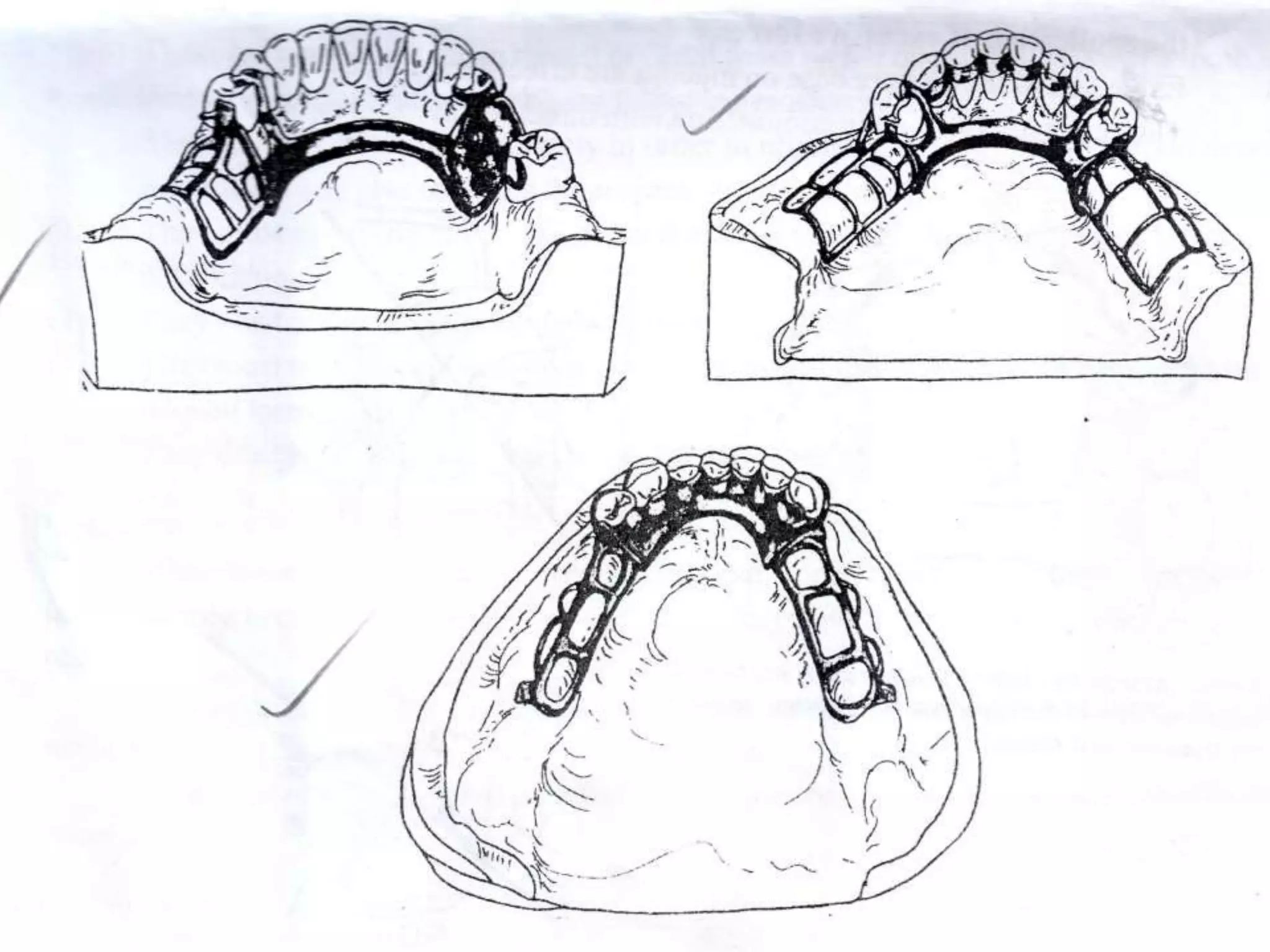 Component Parts of A Partial Denture | PPTX