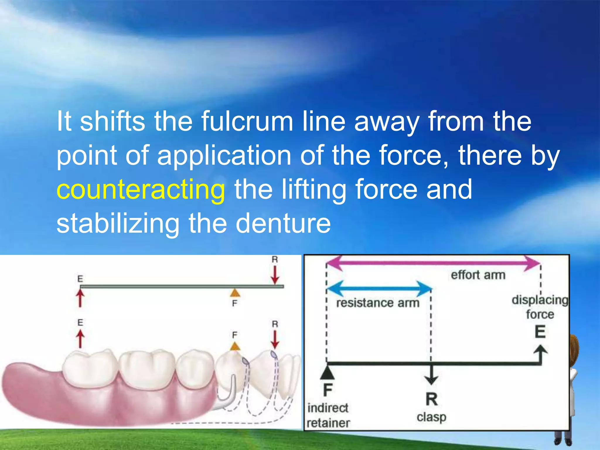 Component Parts of A Partial Denture | PPTX