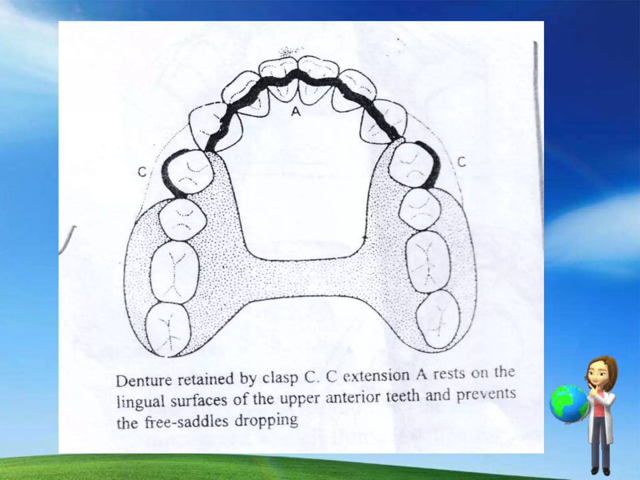 Component Parts of A Partial Denture | PPTX