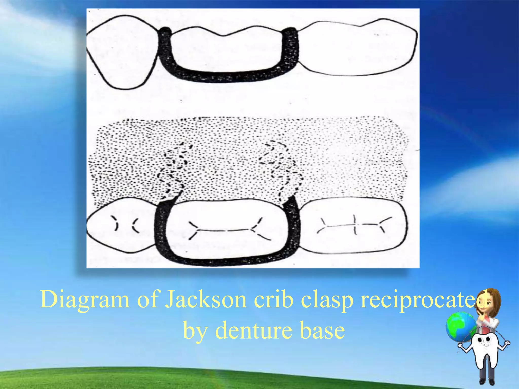 Component Parts of A Partial Denture | PPTX