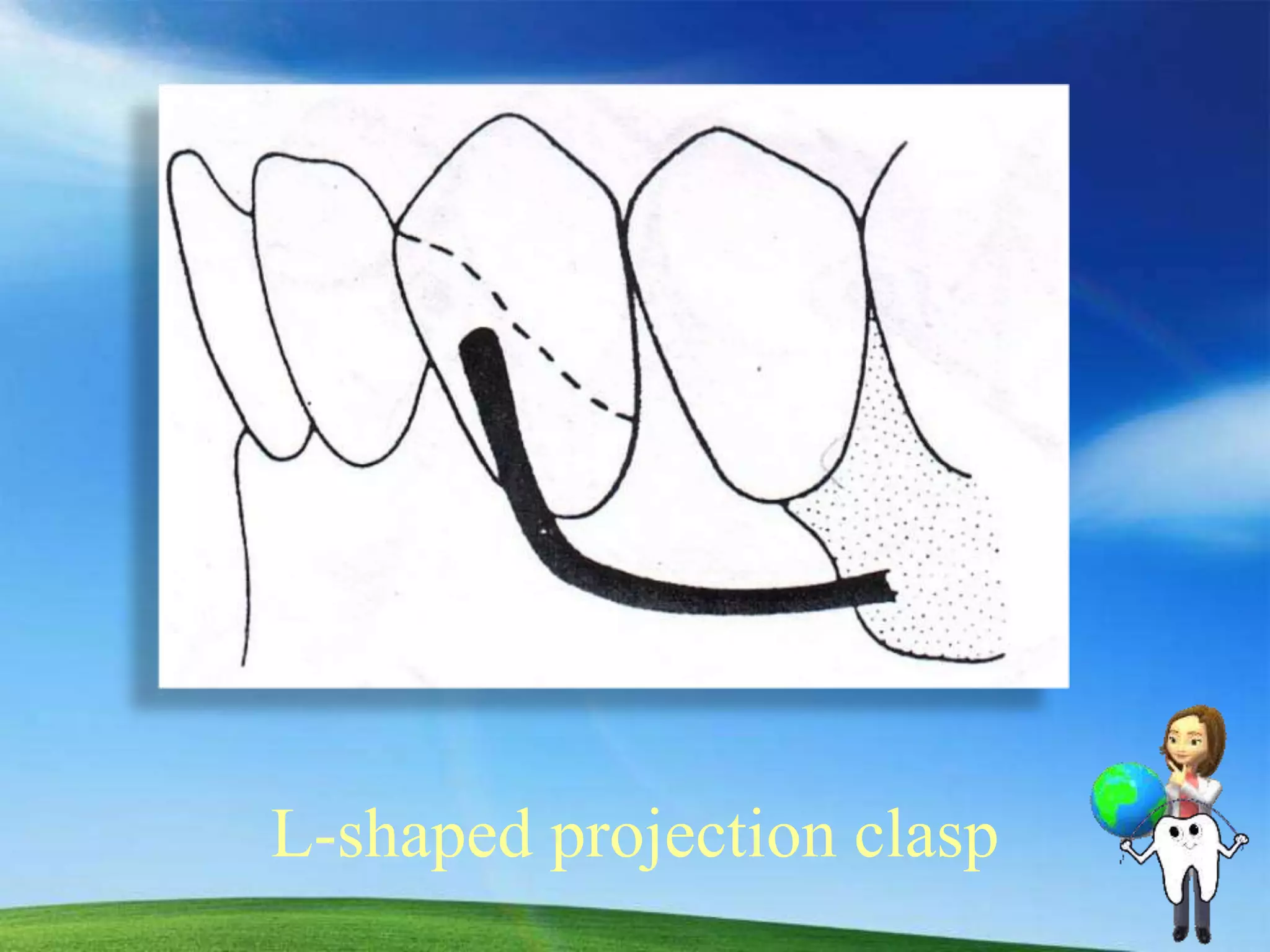Component Parts of A Partial Denture | PPTX