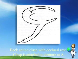 Component Parts of A Partial Denture | PPTX