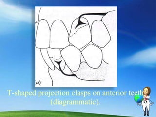 Component Parts of A Partial Denture | PPTX