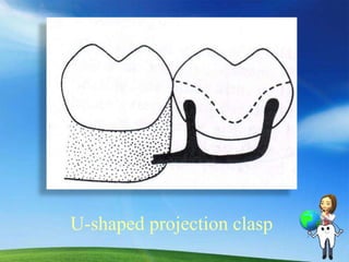 Component Parts of A Partial Denture | PPTX