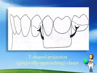 Component Parts of A Partial Denture | PPT
