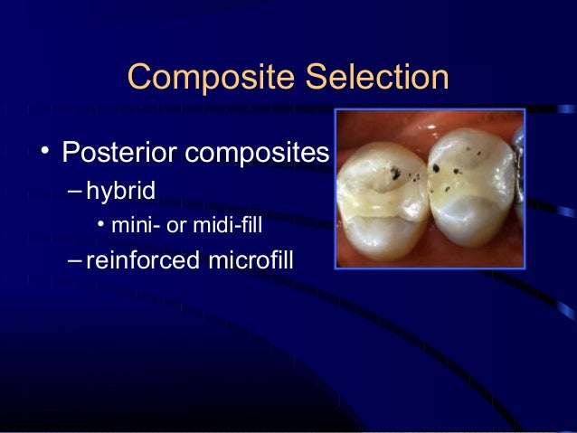 Composite and acid etching