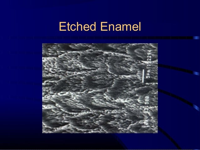 Composite and acid etching