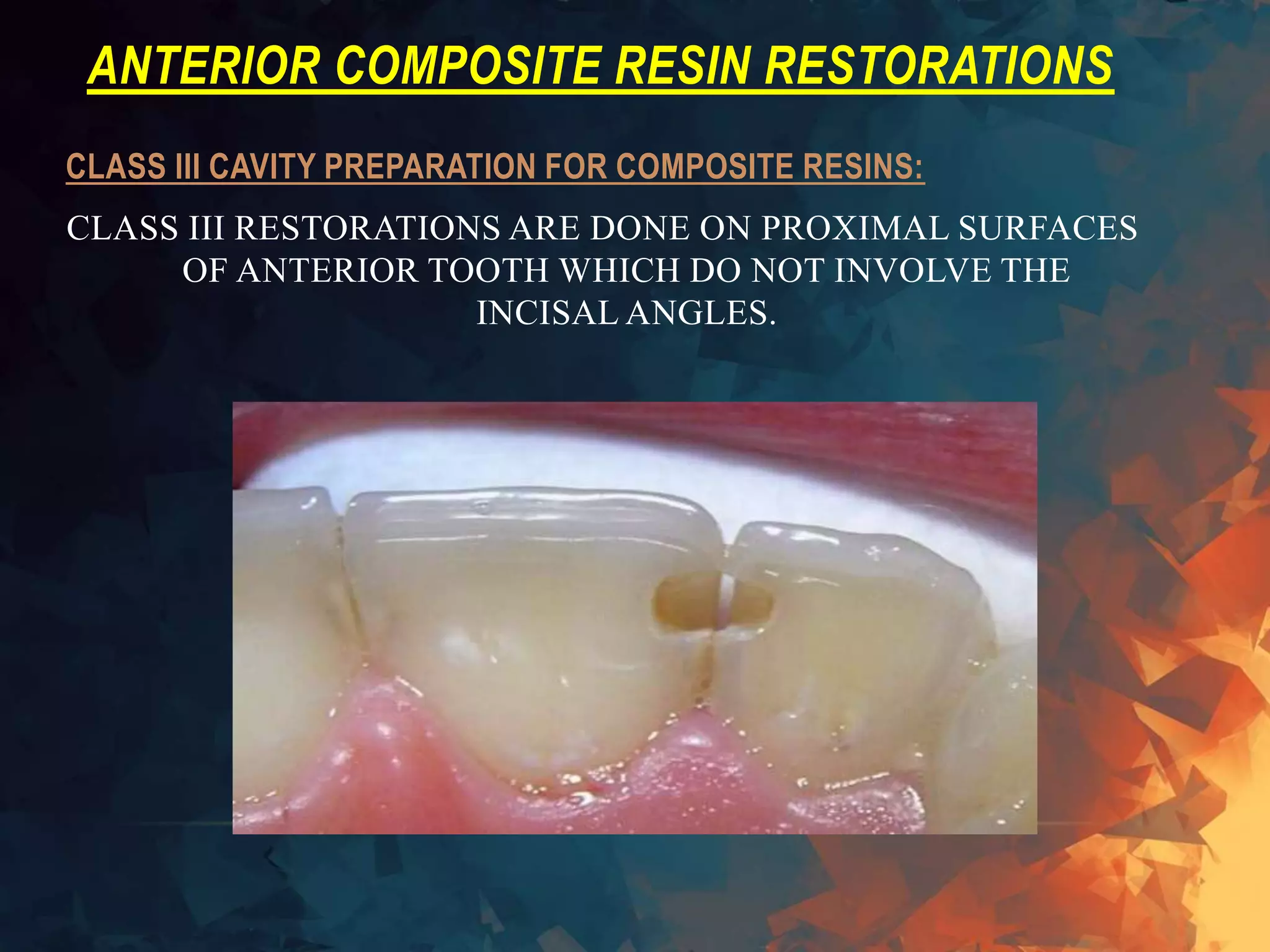 anterior composite restoration | PPTX