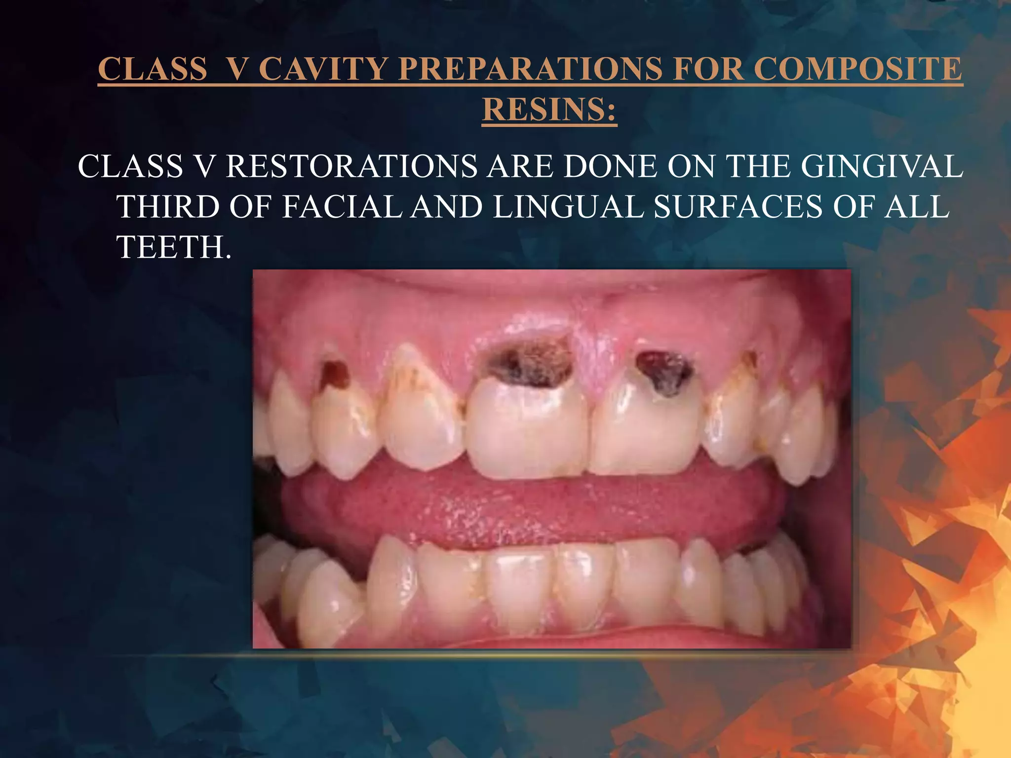 anterior composite restoration | PPTX