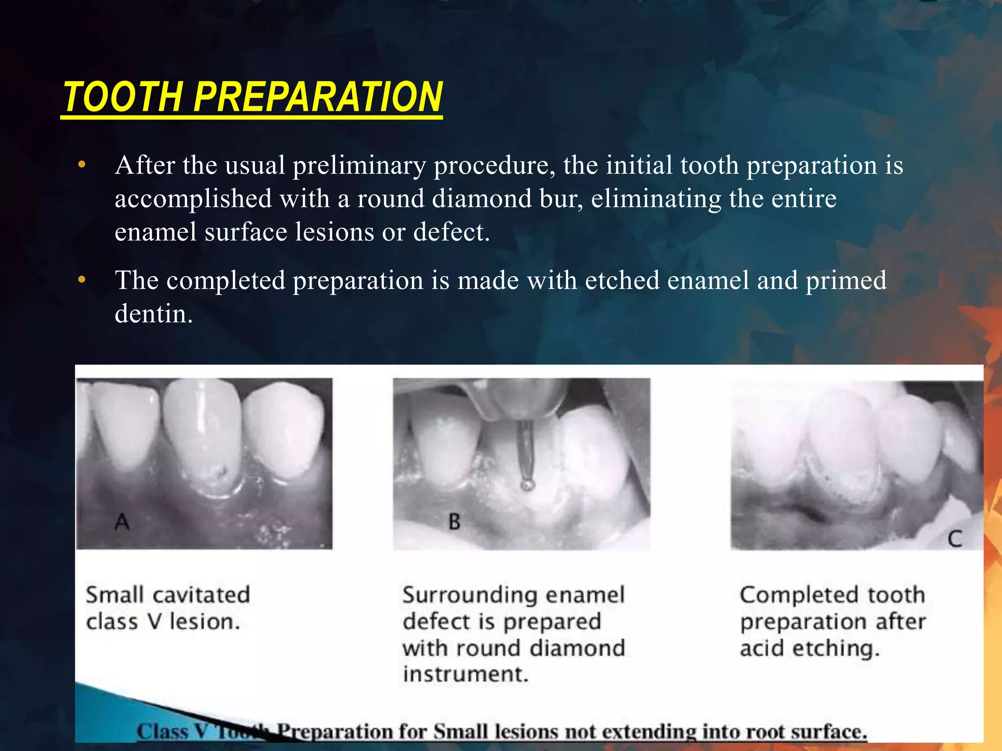 anterior composite restoration | PPTX