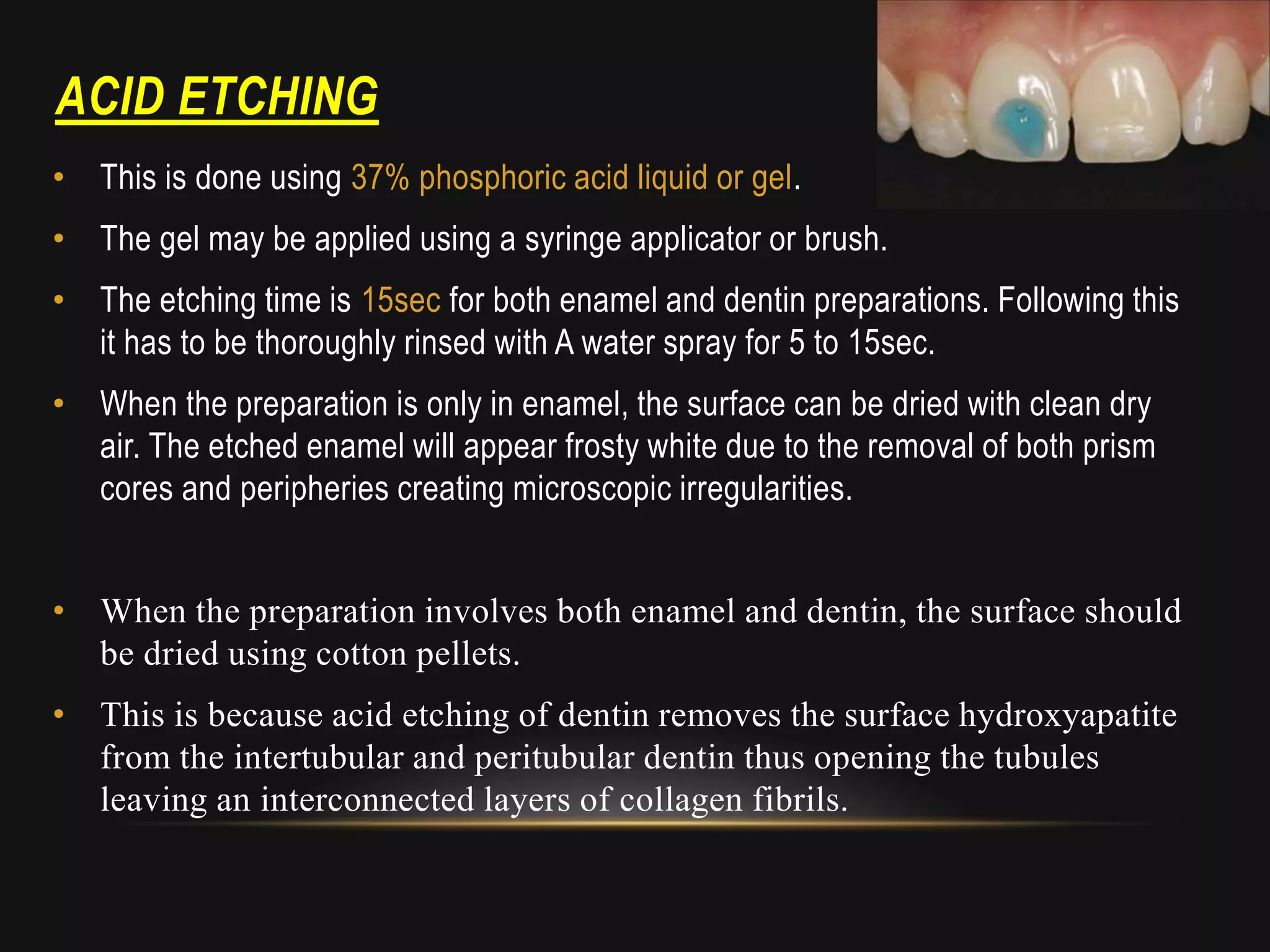 anterior composite restoration | PPTX