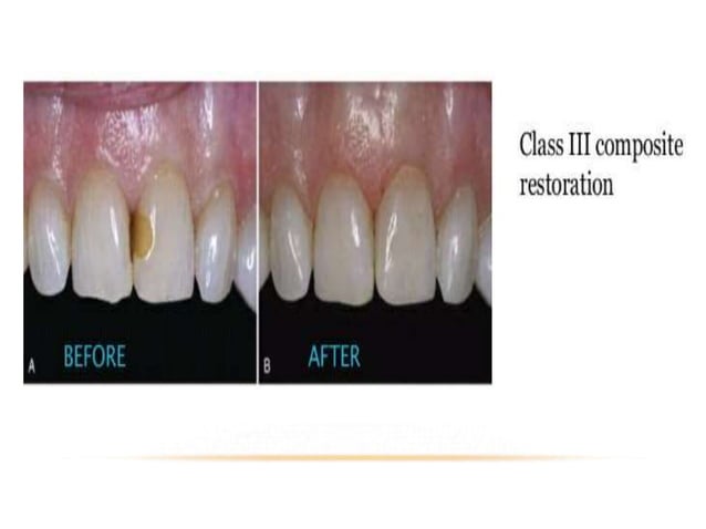 anterior composite restoration | PPTX