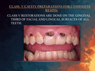 anterior composite restoration | PPTX