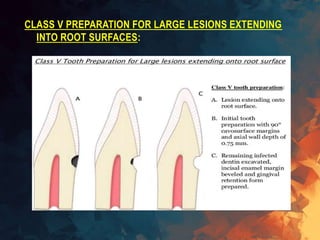 anterior composite restoration | PPTX