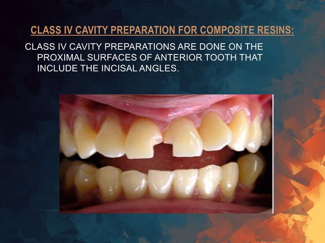 anterior composite restoration | PPTX