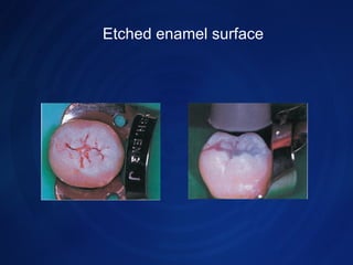 Composite resin technique | PPT