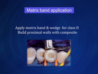 Composite resin technique | PPT