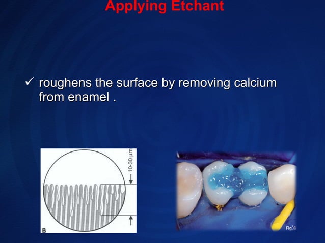 Composite Resin Technique