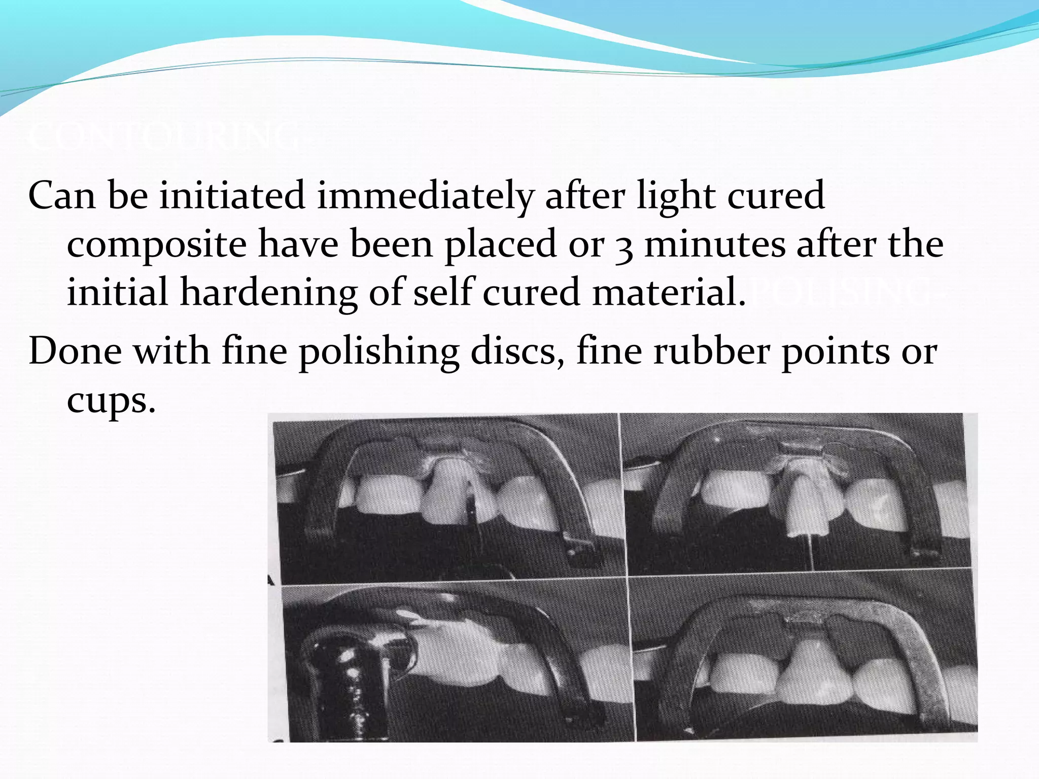 Composite restoration | PPT