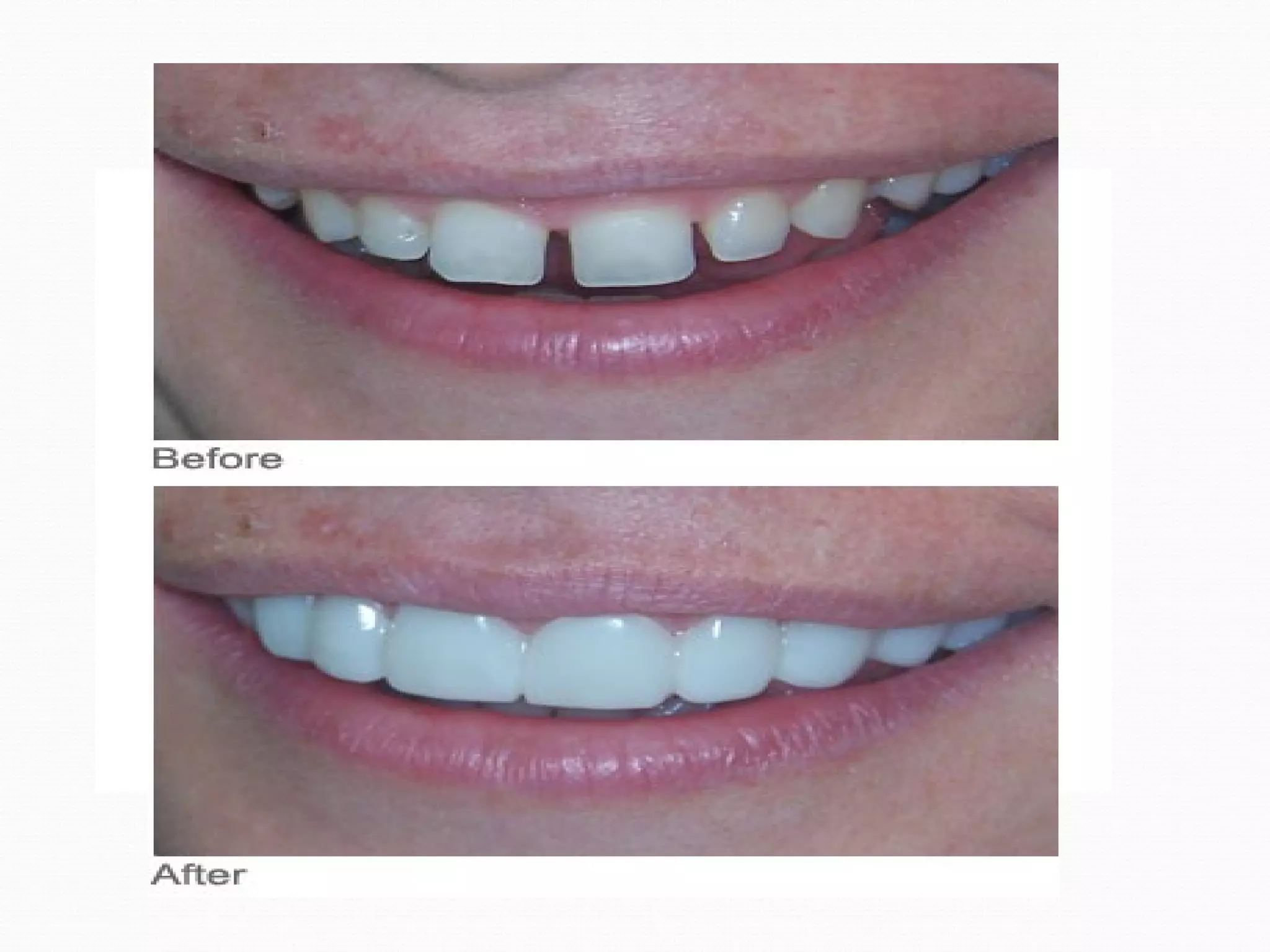 Composite restoration | PPT