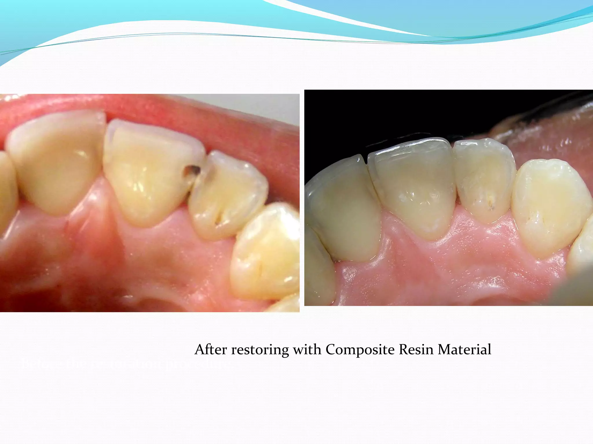 Composite restoration | PPT