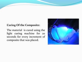 Composite restoration | PPT