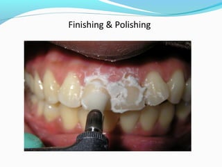 Composite restoration | PPT