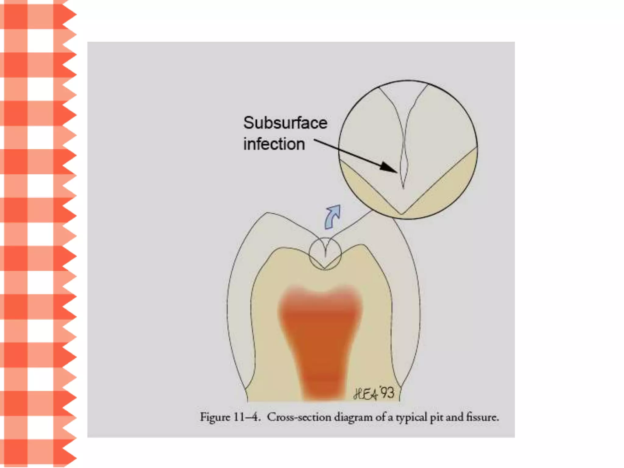 Dental Composites | PPTX