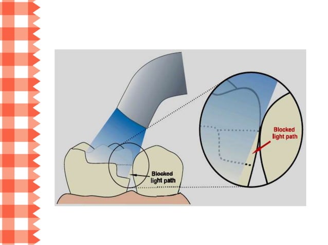 Dental Composites | PPTX