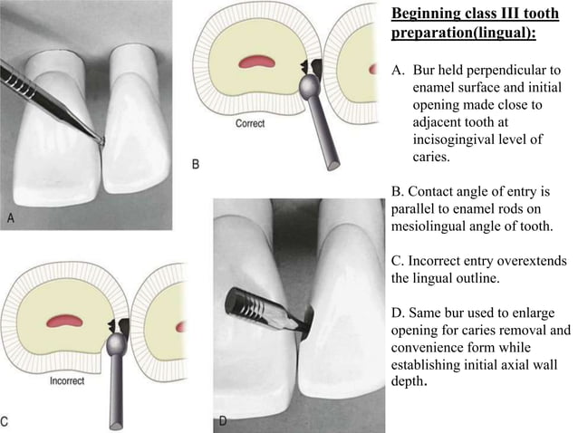 Composite class 3 and class 5 | PPTX | Dental Health | Diseases and ...