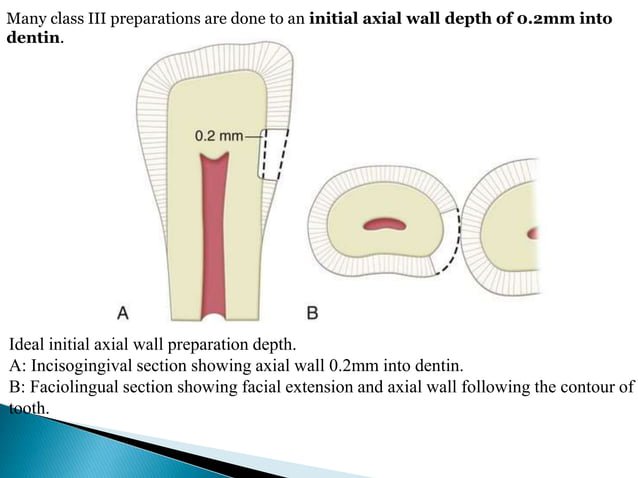 Composite class 3 and class 5 | PPTX | Dental Health | Diseases and ...