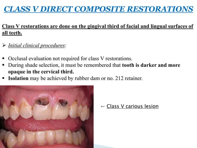Composite class 3 and class 5 | PPTX | Dental Health | Diseases and ...
