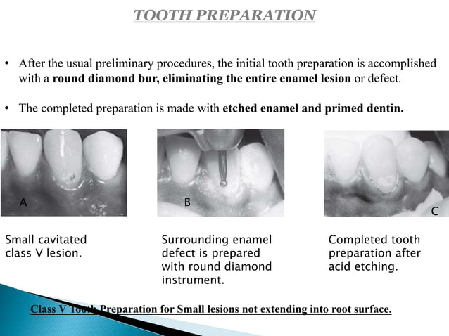 Composite class 3 and class 5 | PPTX | Dental Health | Diseases and ...