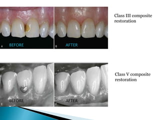 Composite class 3 and class 5 | PPTX