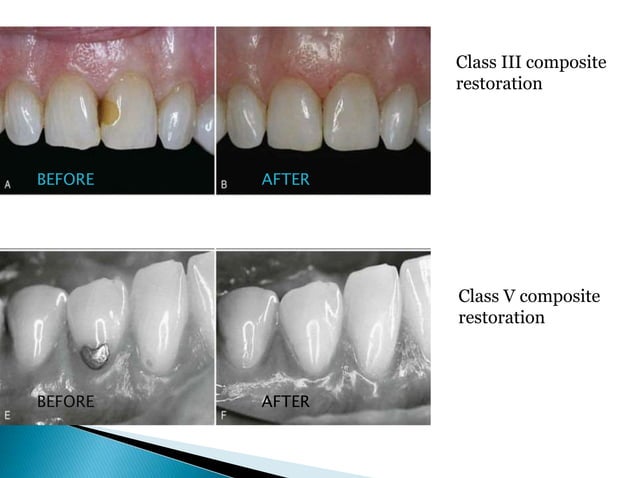 Composite class 3 and class 5 | PPTX | Dental Health | Diseases and ...