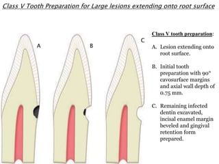 Composite class 3 and class 5 | PPT
