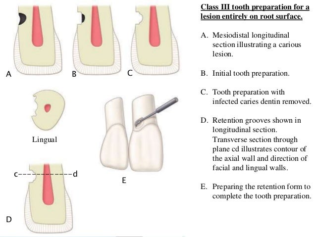 Composite class 3 and class 5